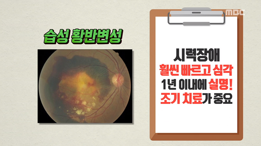 완치 어려운 실명 질환 1위 황반변성은