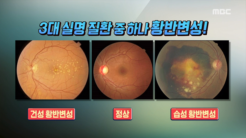 완치 어려운 실명 질환 1위 황반변성은